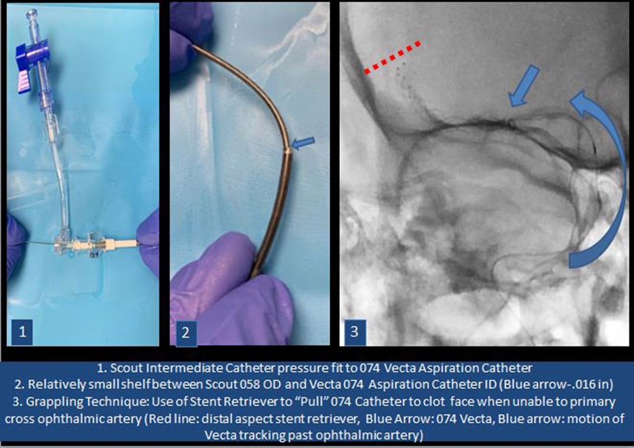 Thrombus Aspiration Catheter Price Starting From Rs 4/Pc | Find ...