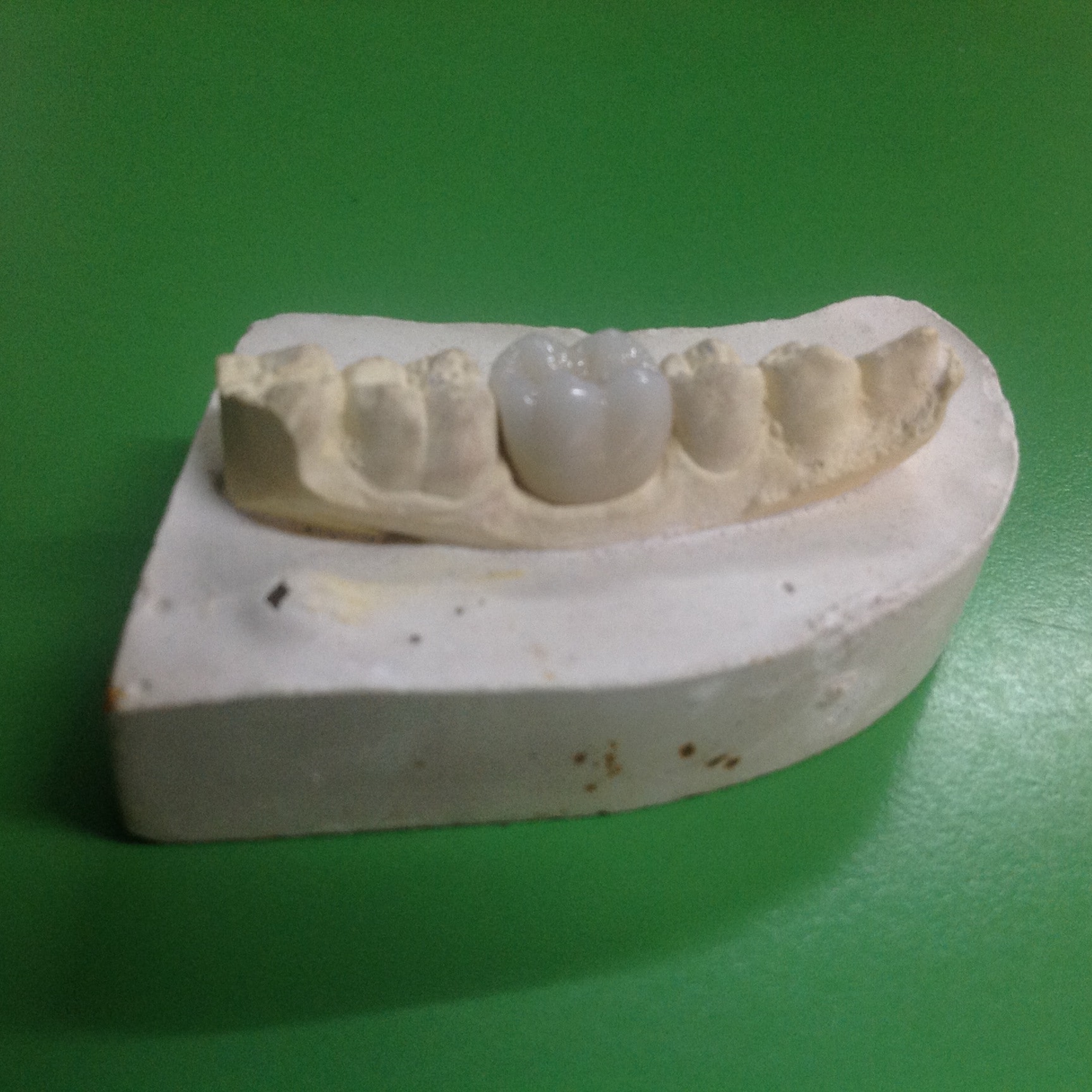 Top Artificial Teeth Manufacturers in Rajavali - Best Artificial Teeth ...